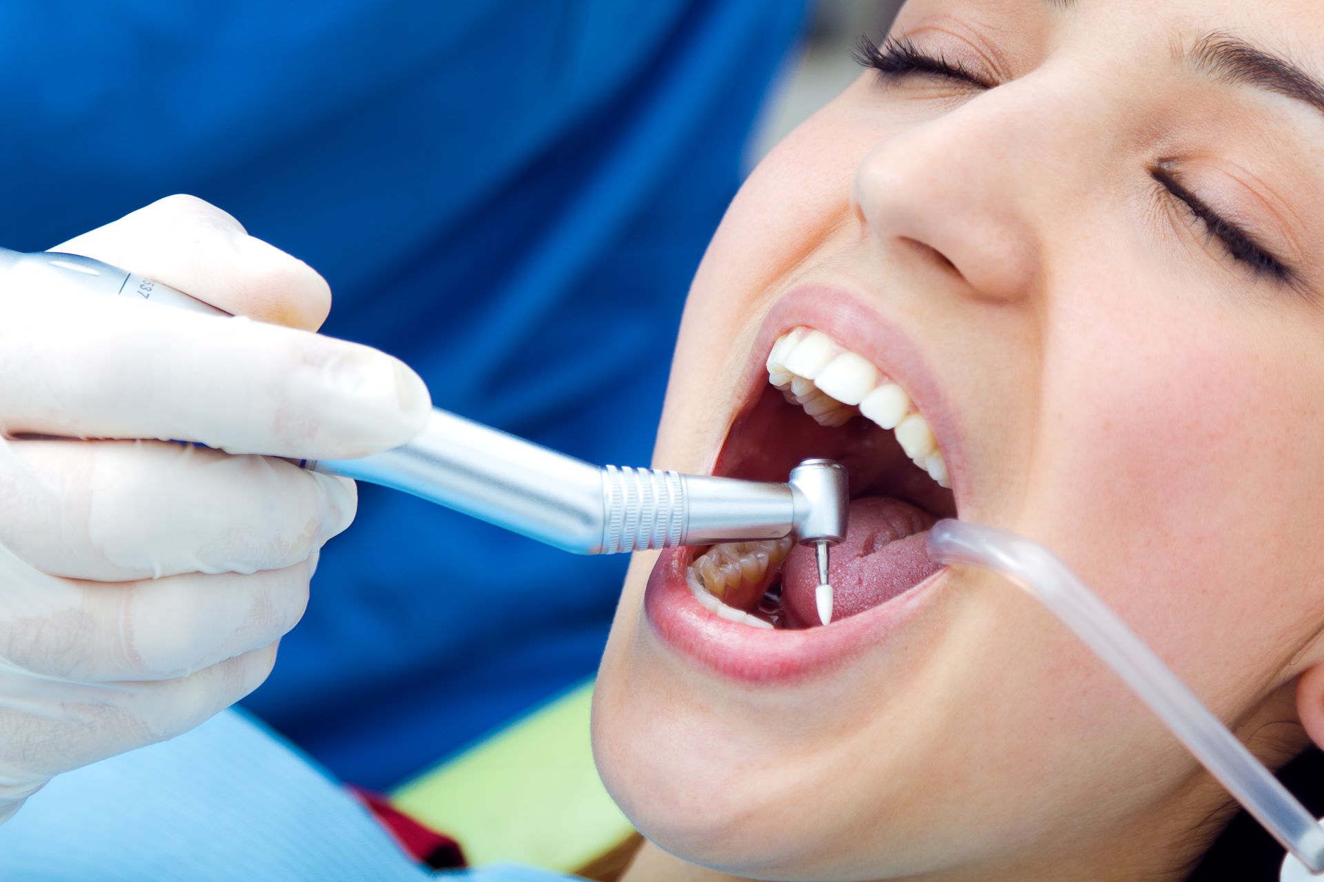 Aesthetic Filling - DT. Alperen Aydın